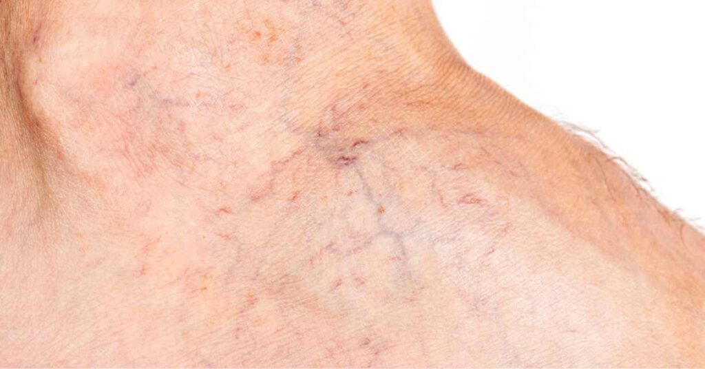 What is Varicose Eczema? – Medical Centric