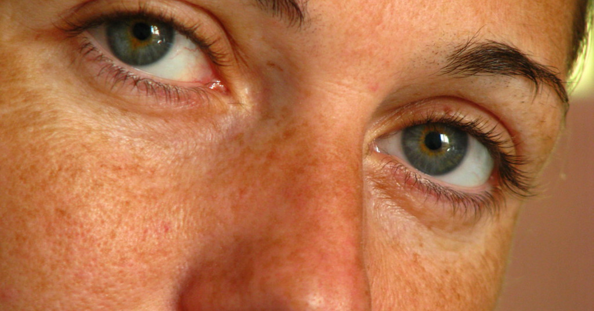 FRECKLES – Medical Centric