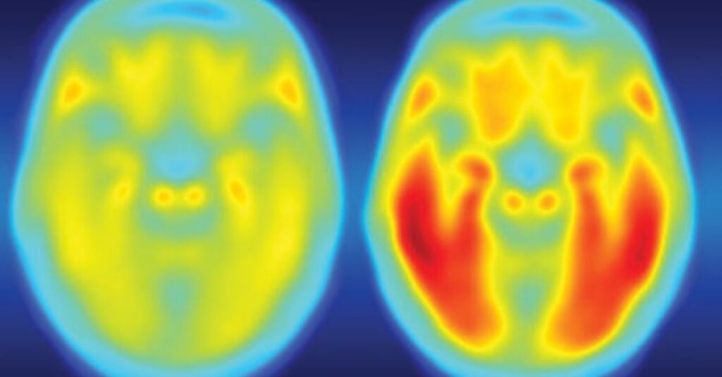 CHRONIC TRAUMATIC ENCEPHALOPATHY (CTE) – Medical Centric