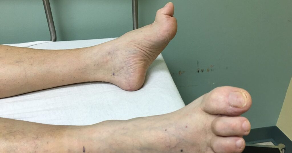 Hammer Toe or Mallet Toe: What You Need to Know – Medical Centric