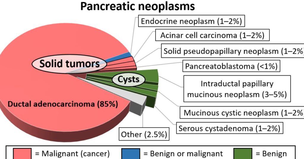 Pancreatic Cysts: Causes, Symptoms, Diagnosis, and Treatment – Medical ...