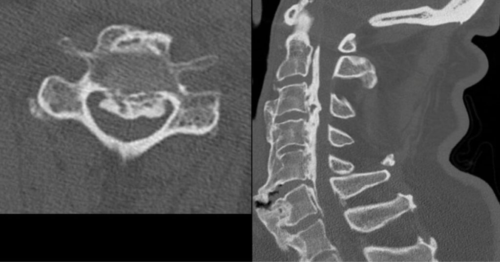 DIFFUSE IDIOPATHIC SKELETAL HYPEROSTOSIS (DISH) – Medical Centric