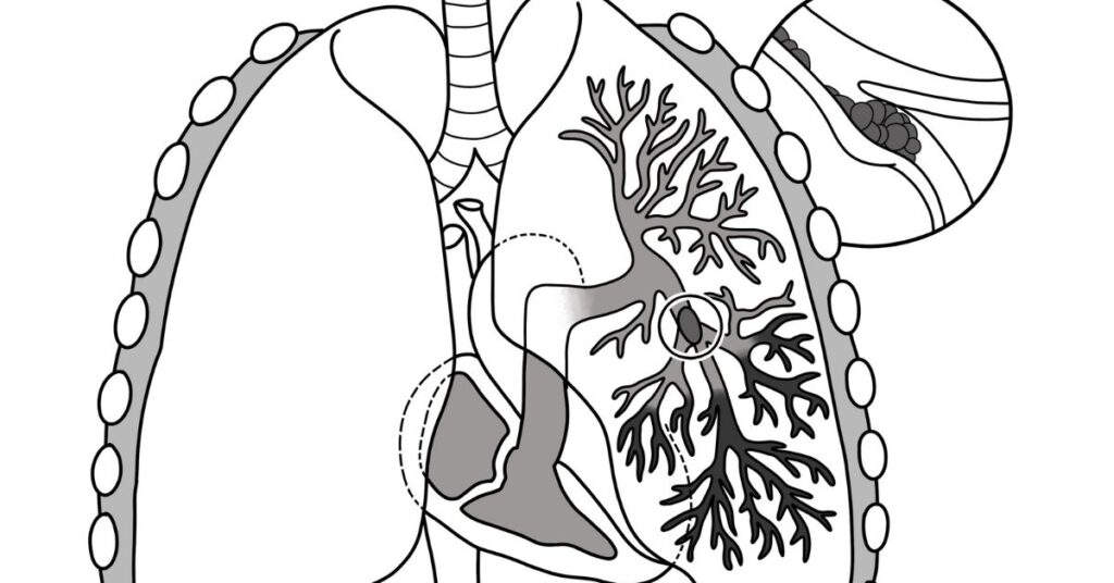 PULMONARY EMBOLISM (PE) – Medical Centric