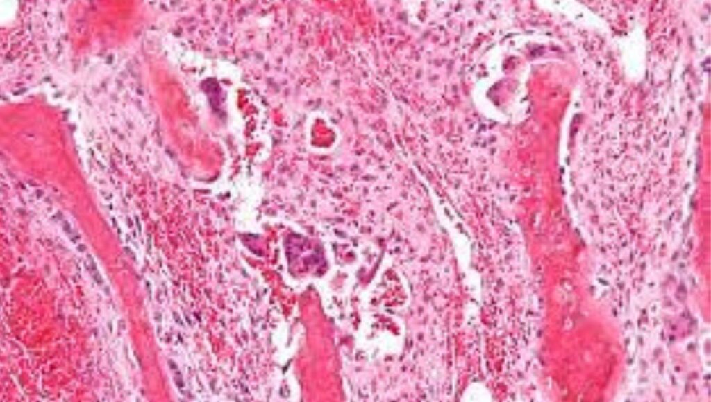 HYPERCALCEMIA – Medical Centric