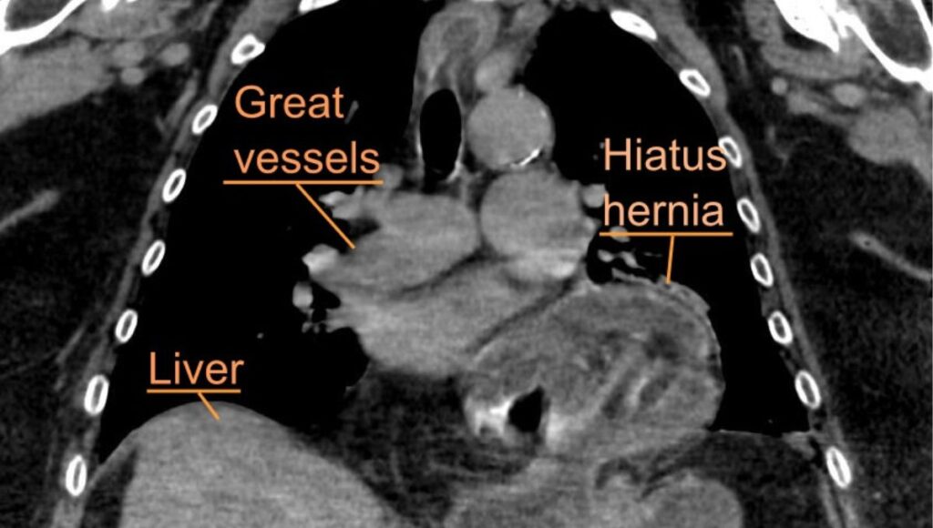 HIATAL HERNIA – Medical Centric