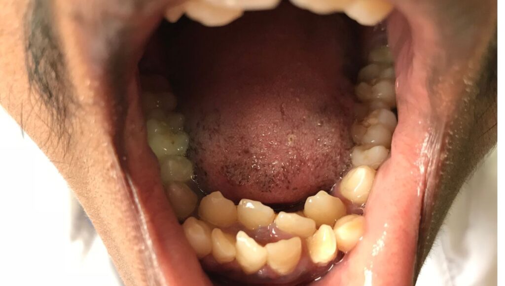 HYPERDONTIA – Medical Centric