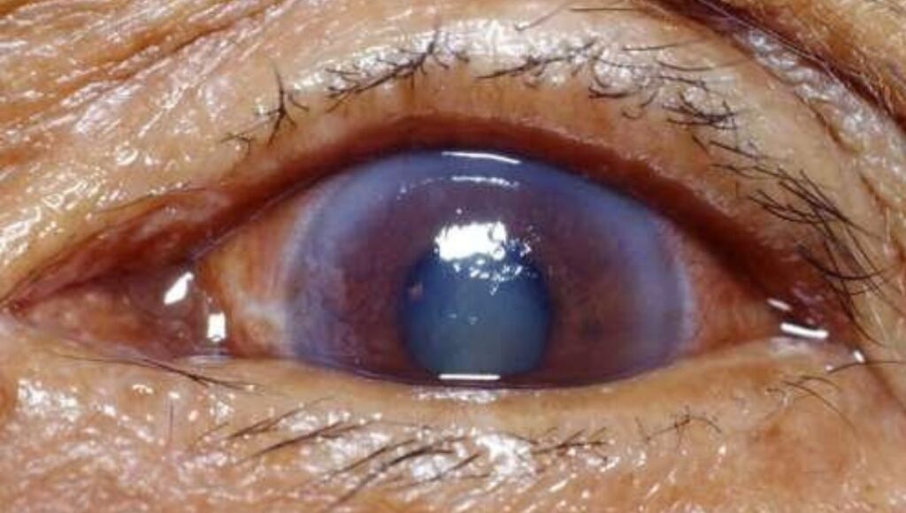 GLAUCOMA – Medical Centric