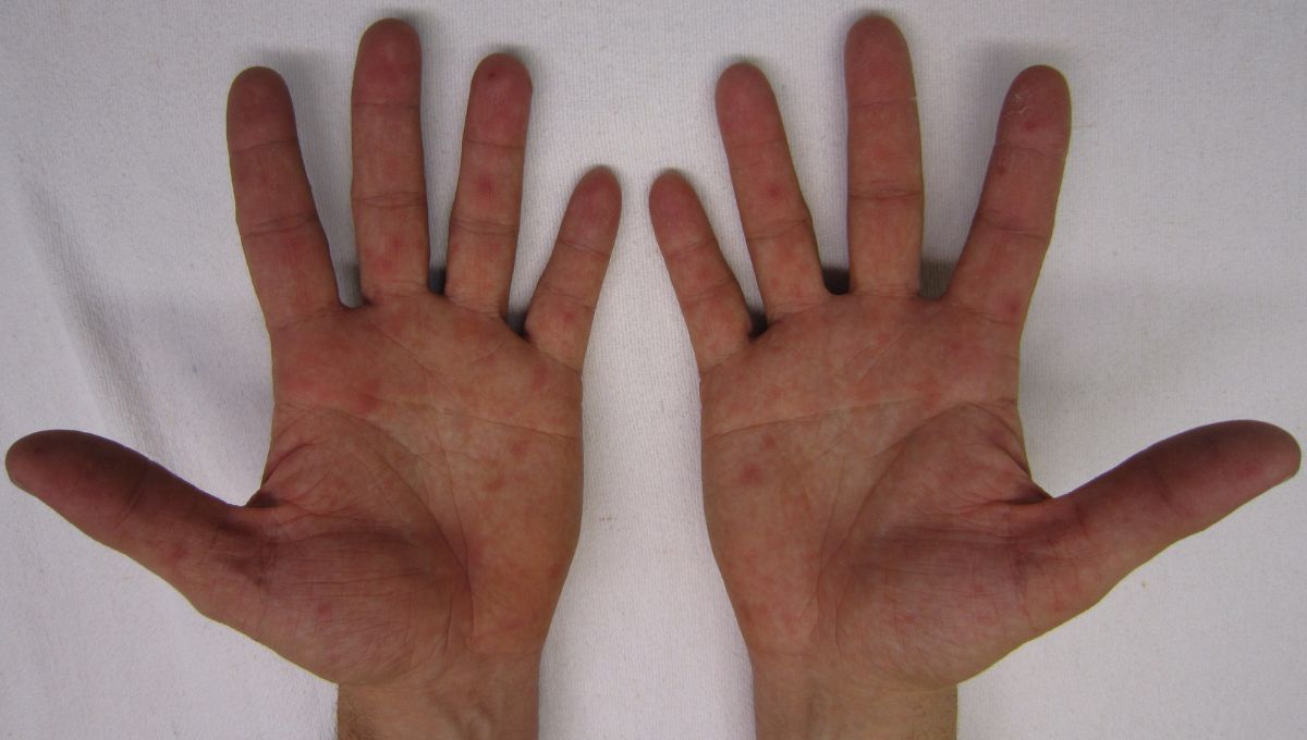 WHAT IS CHEMOTHERAPY HAND-FOOT SYNDROME – Medical Centric